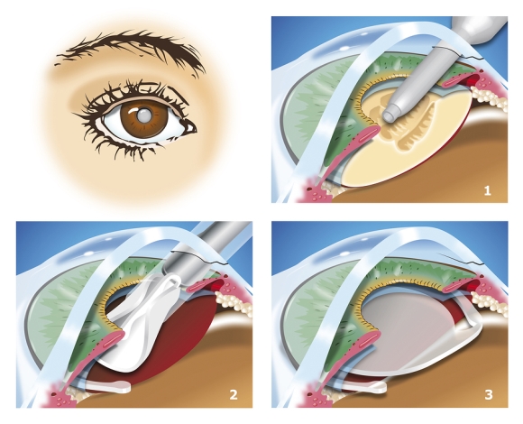 A Brief Overview of Cornea Implants