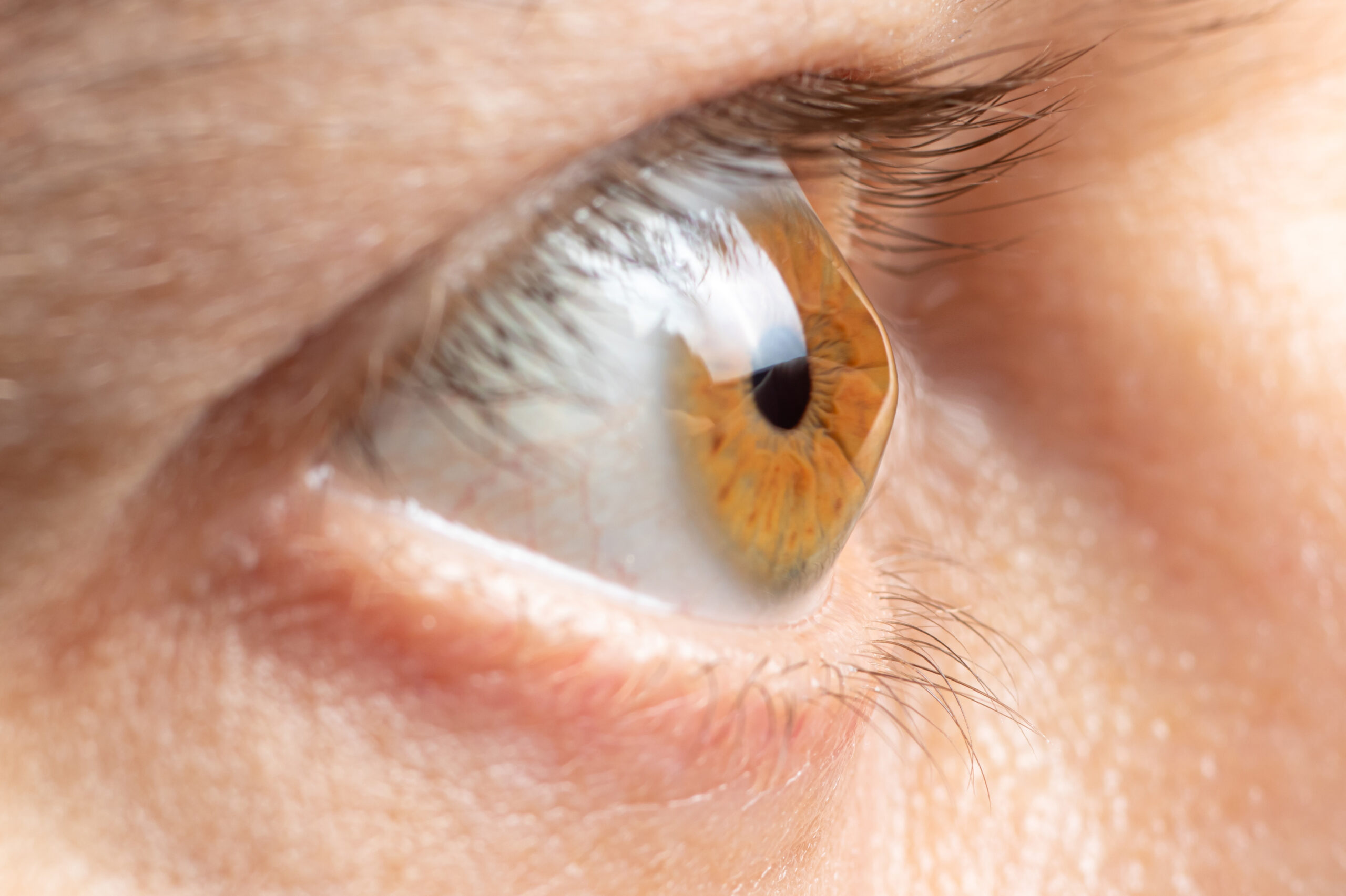5 Misconceptions about Keratoconus – Mack Eye Center