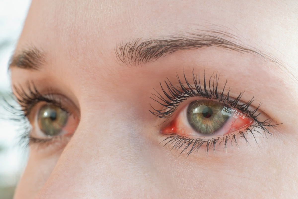 Meibomian Gland Dysfunction Contributes to Dry Eye in Hoffman Estates
